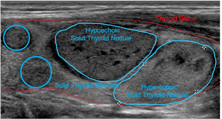 Normal vs. Abnormal Thyroid on Ultrasound - RFA For Life